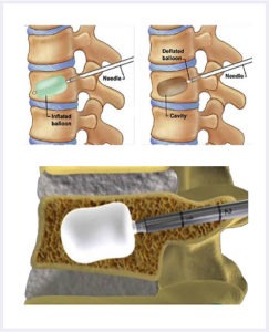 Kyphoplasty and Sacroplasty for Compression Fractures- Back Pain Treatment