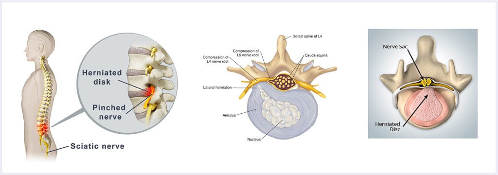 Sciatica Pain Treatment Options - Back Pain Treatment
