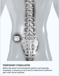 Spinal Column and Peripheral Nerve Stimulator - Back Pain Treatment