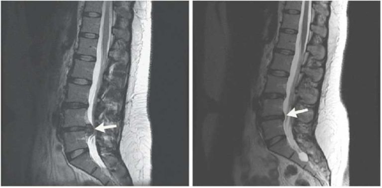 Intervertebral Disc Disease Treatment - Discseel - Back Pain Treatment