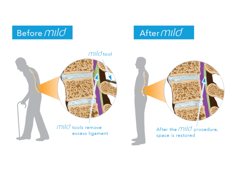 MILD Procedure for Spinal Stenosis- Back Pain Treatment